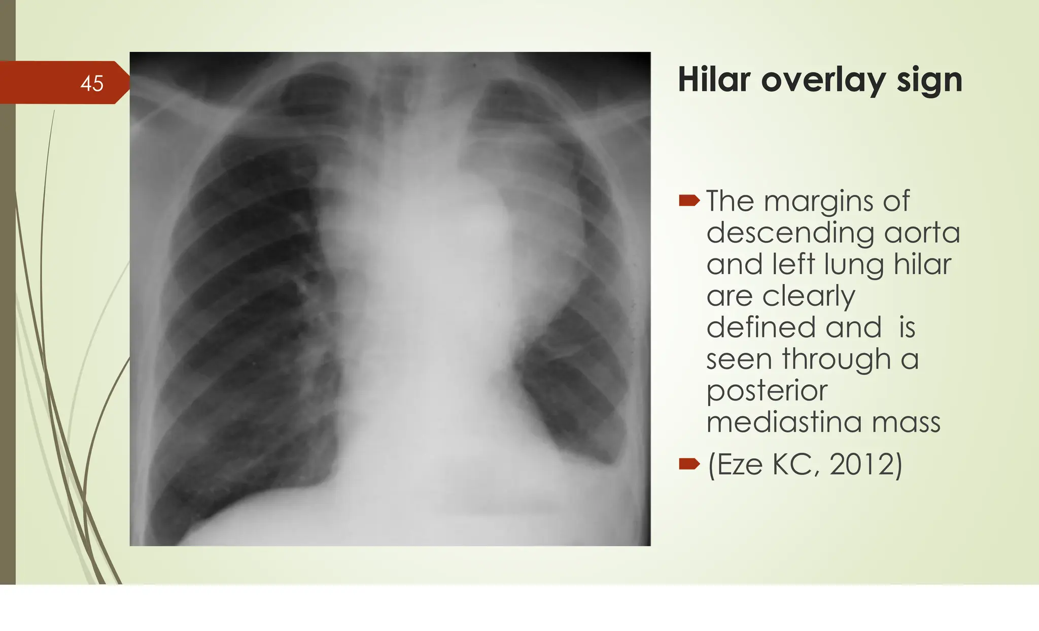 RADIOLOGICAL ANATOMY OF THE MEDIASTINUM.PDF