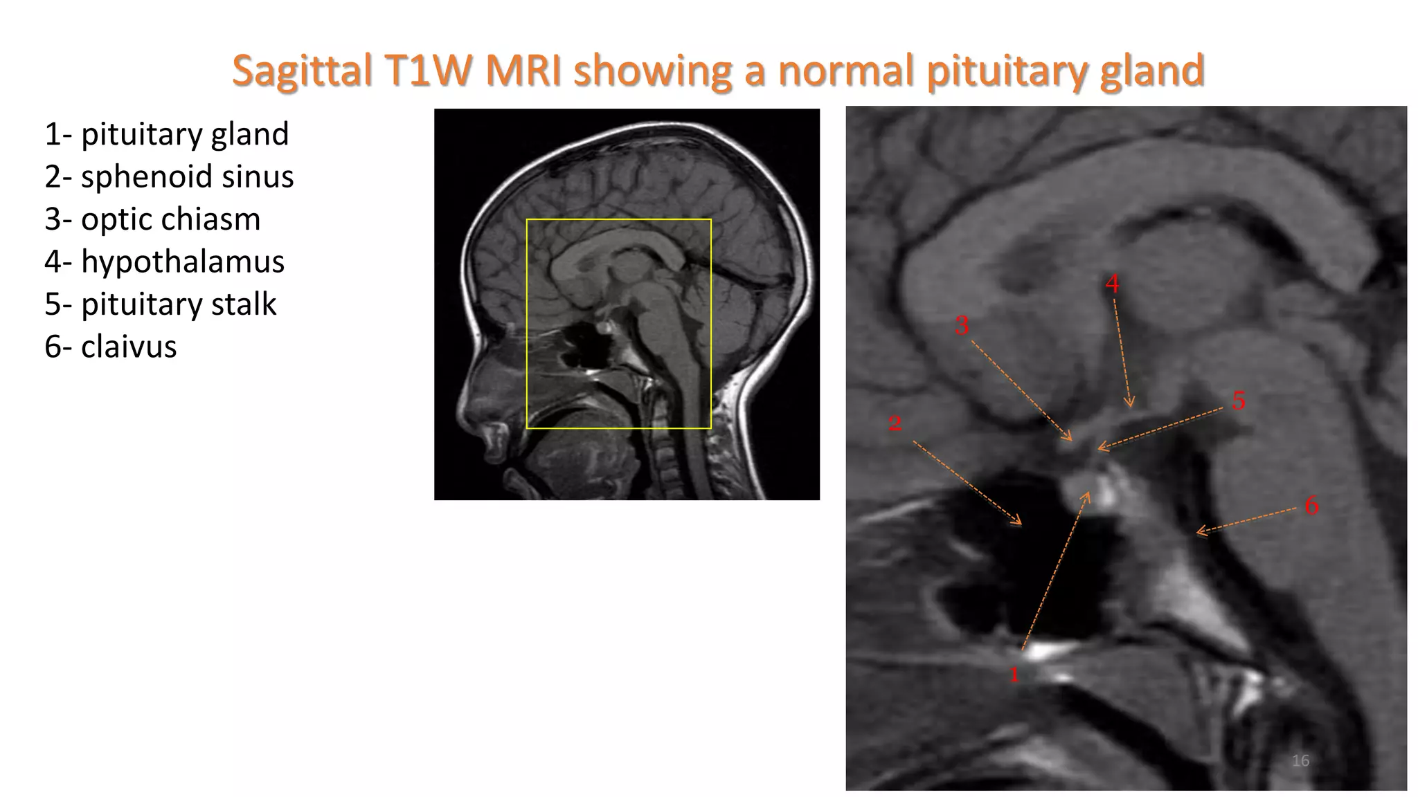 RADIOLOGICAL ANATOMY OF THE PITUITARY GLAND AND TECHNIQUES.pptx
