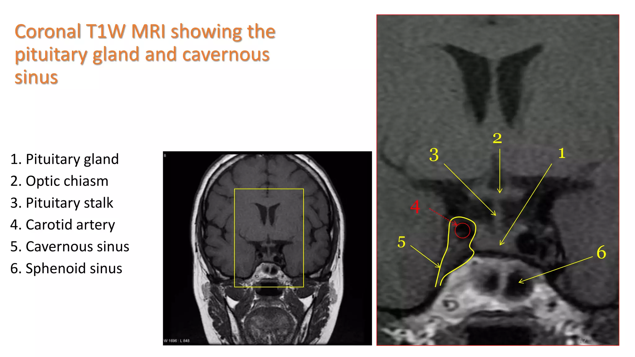 RADIOLOGICAL ANATOMY OF THE PITUITARY GLAND AND TECHNIQUES.pptx