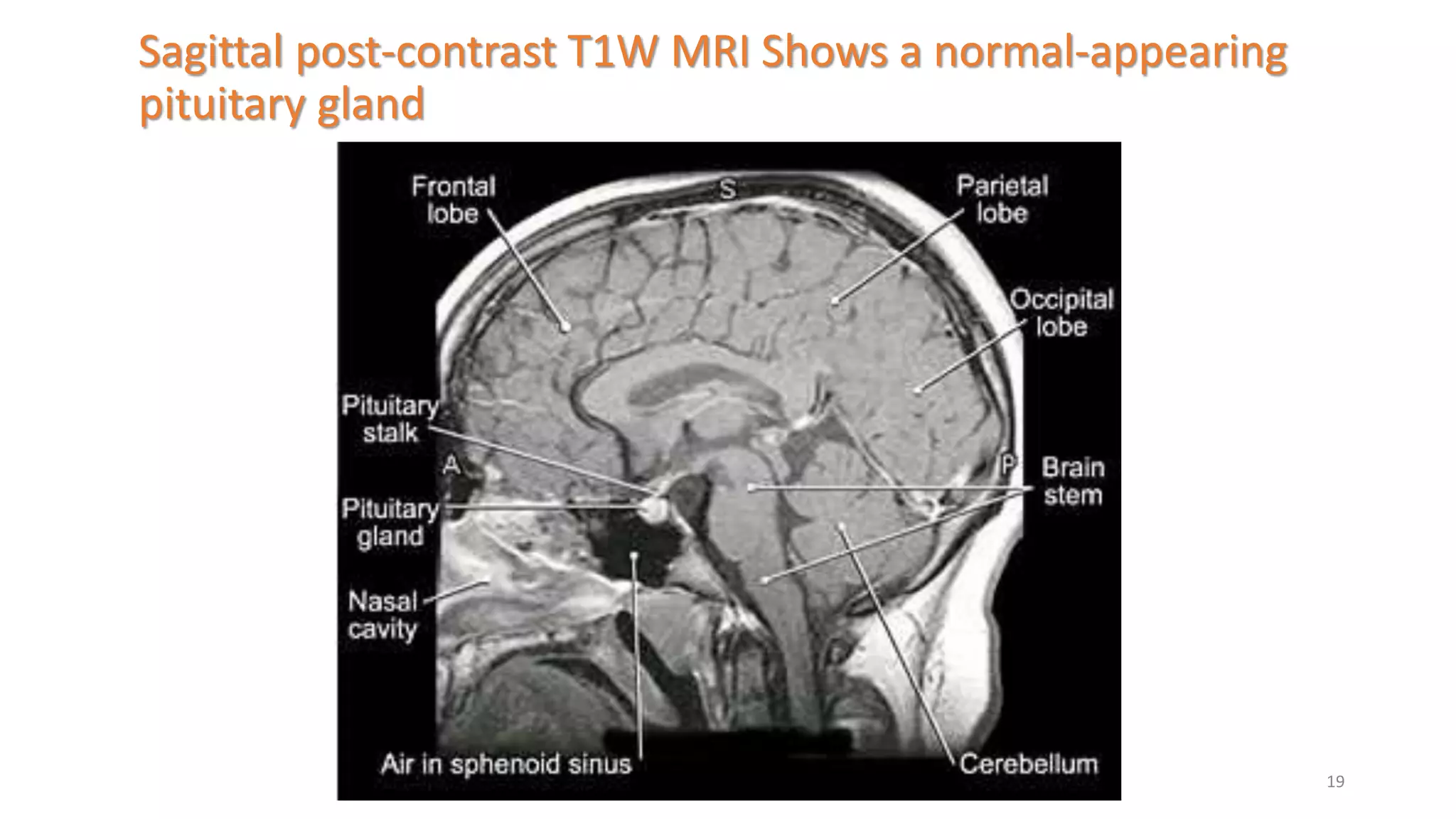 RADIOLOGICAL ANATOMY OF THE PITUITARY GLAND AND TECHNIQUES.pptx