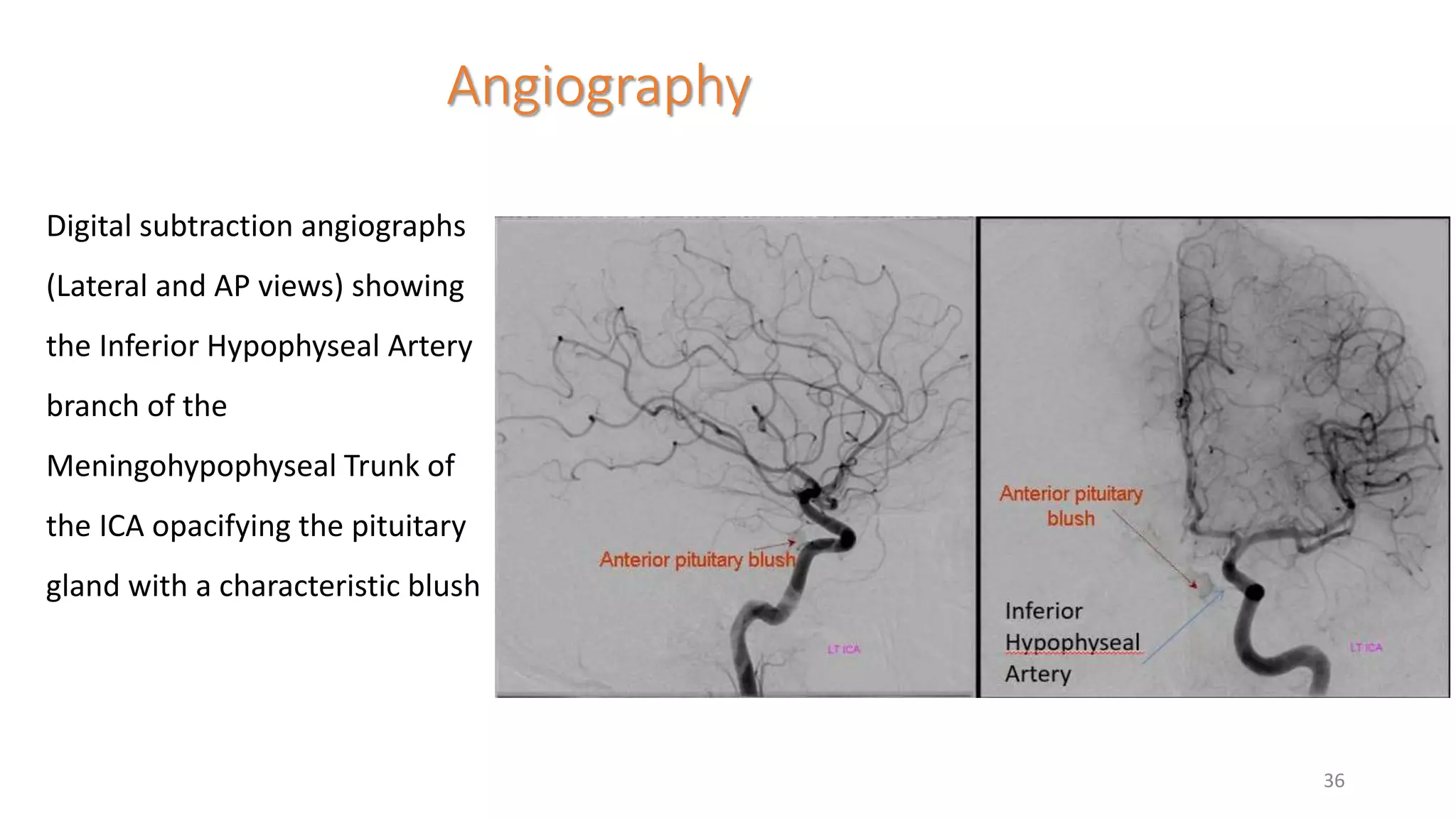 RADIOLOGICAL ANATOMY OF THE PITUITARY GLAND AND TECHNIQUES.pptx