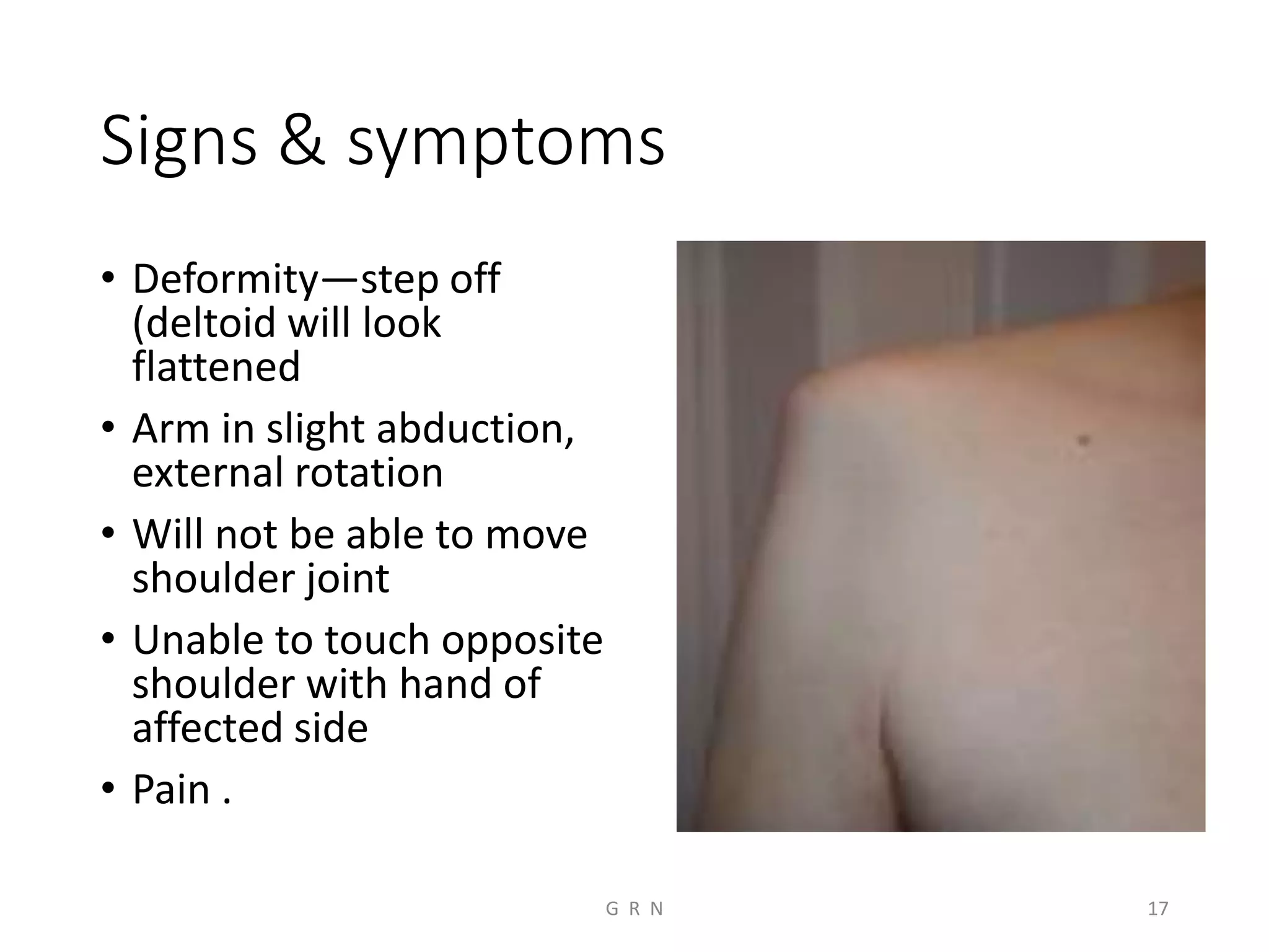 Radiological anatomy of the upper limb r | PDF