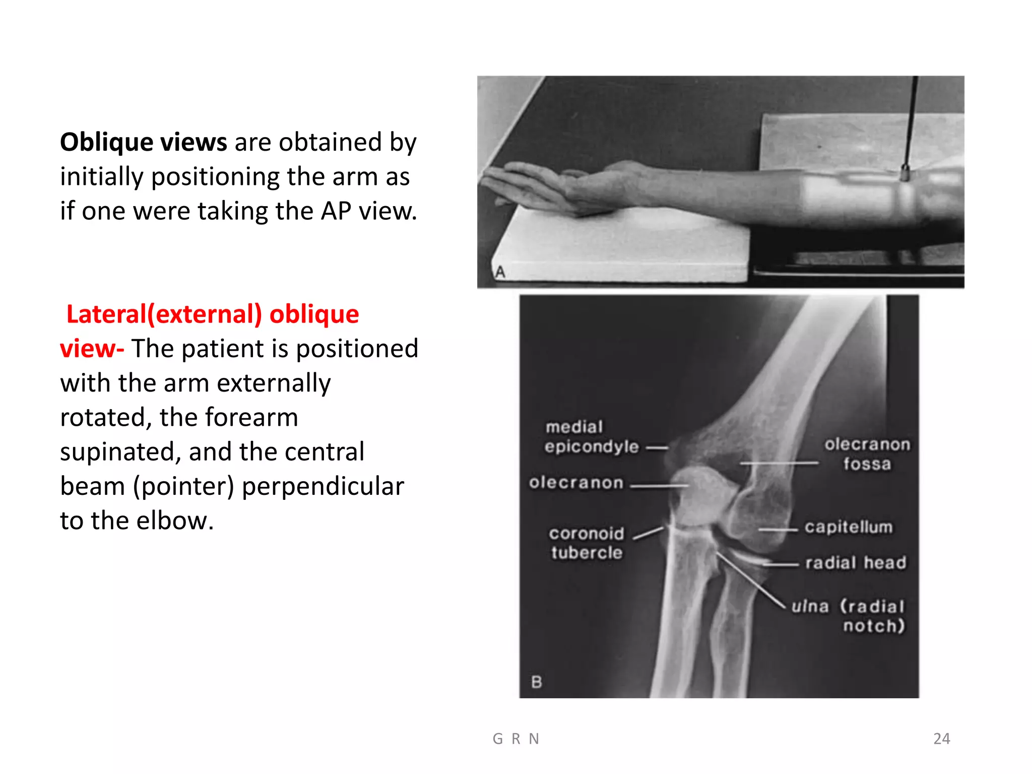 Radiological anatomy of the upper limb r | PDF