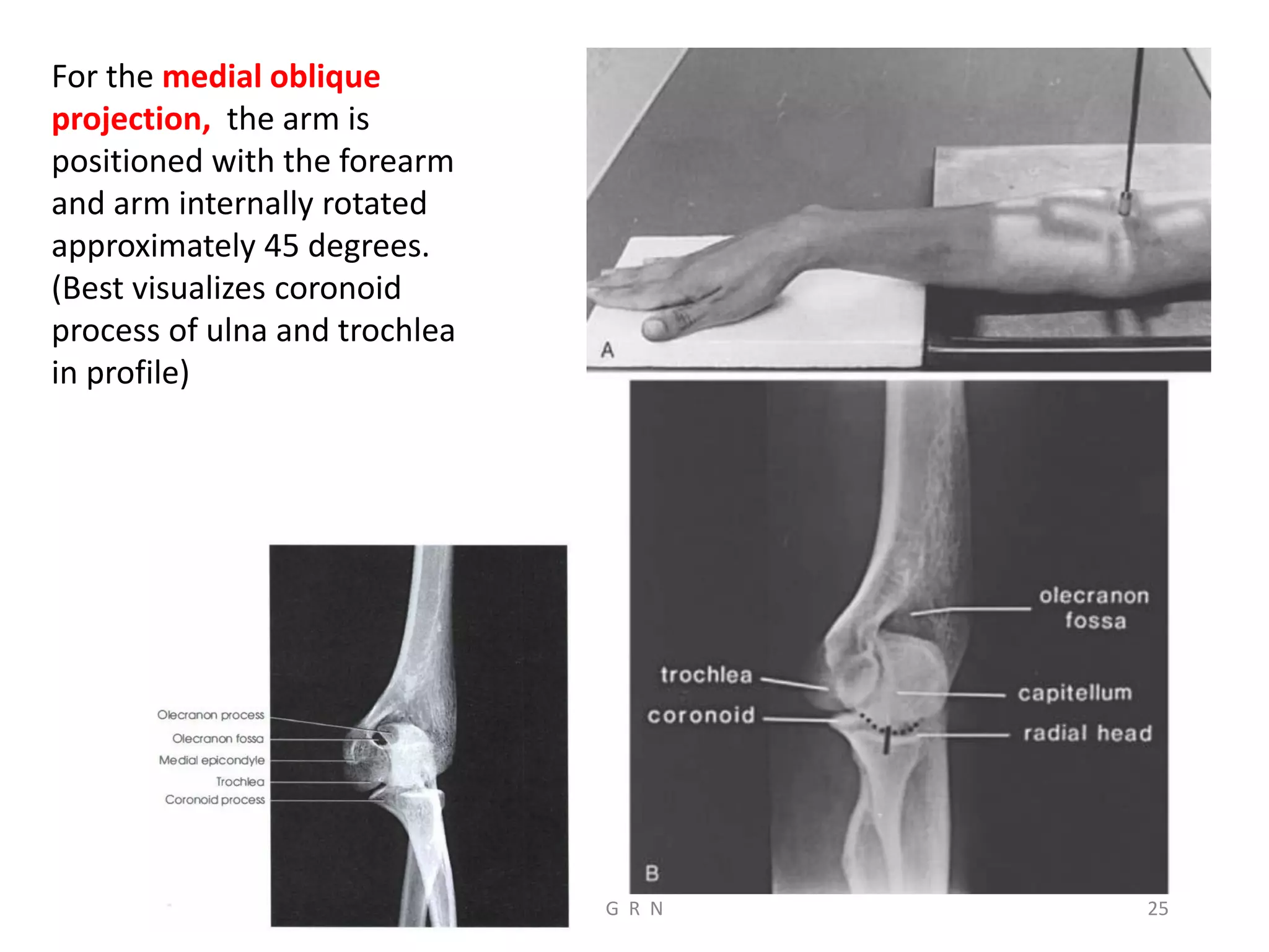 Radiological anatomy of the upper limb r | PDF