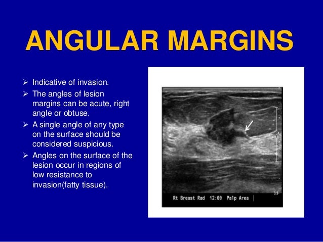 Radiological approach for malignant breast lesions