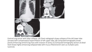 Radiological approach to lung neoplasms | PPTX