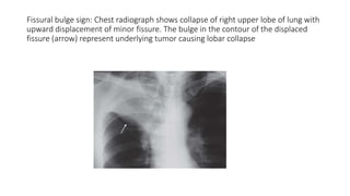 Radiological approach to lung neoplasms | PPTX