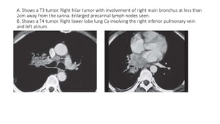 Radiological approach to lung neoplasms | PPTX
