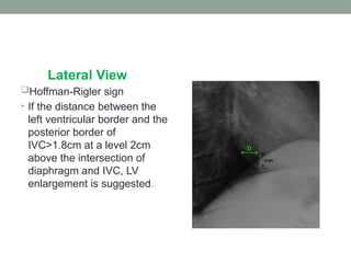 Radiological Cardiac Anatomyjhdcdsdsdkd.pptx