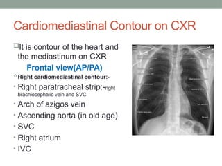 Radiological Cardiac Anatomyjhdcdsdsdkd.pptx