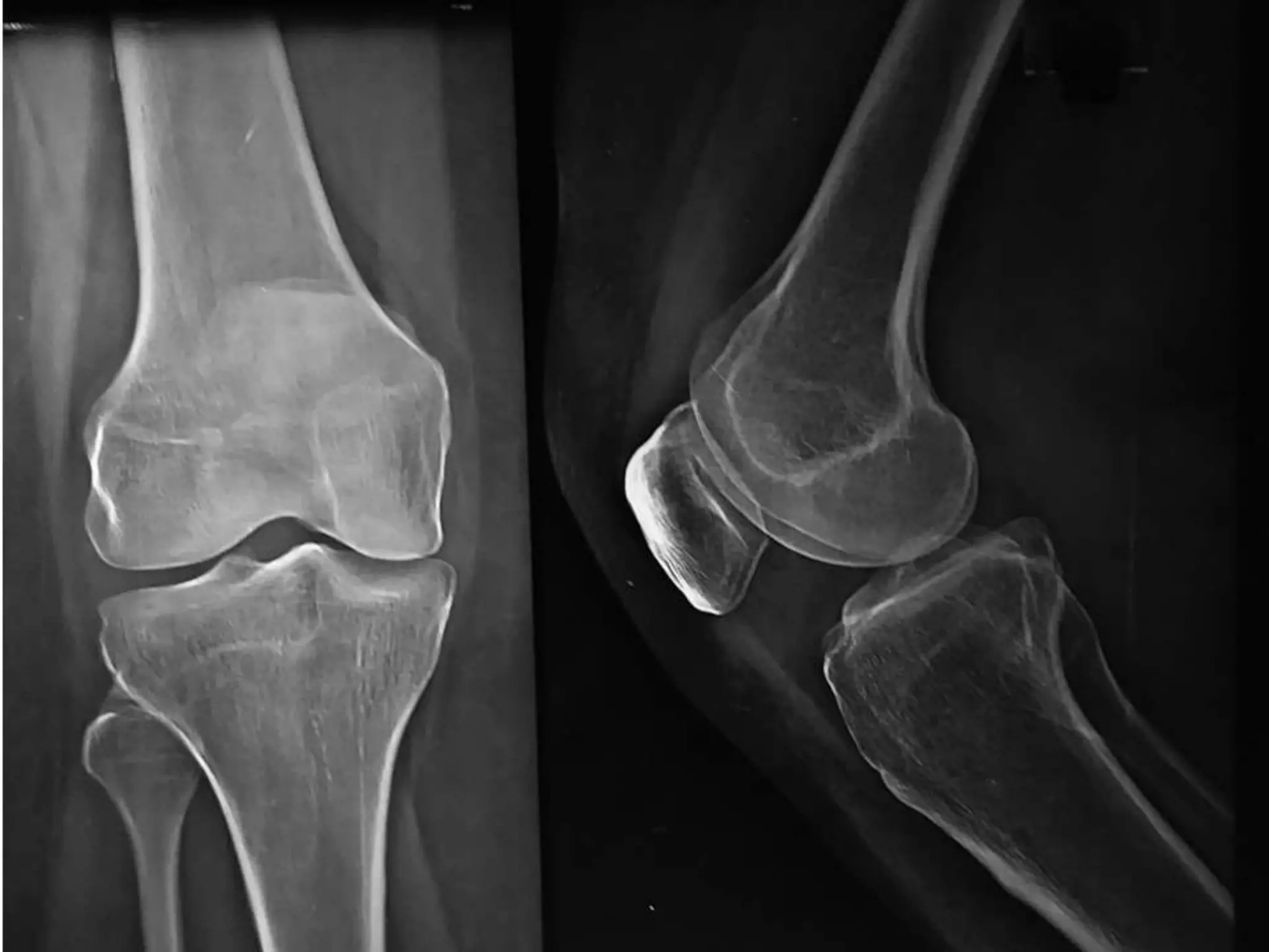 Radiological changes in Patella in Prediabetes.pptx