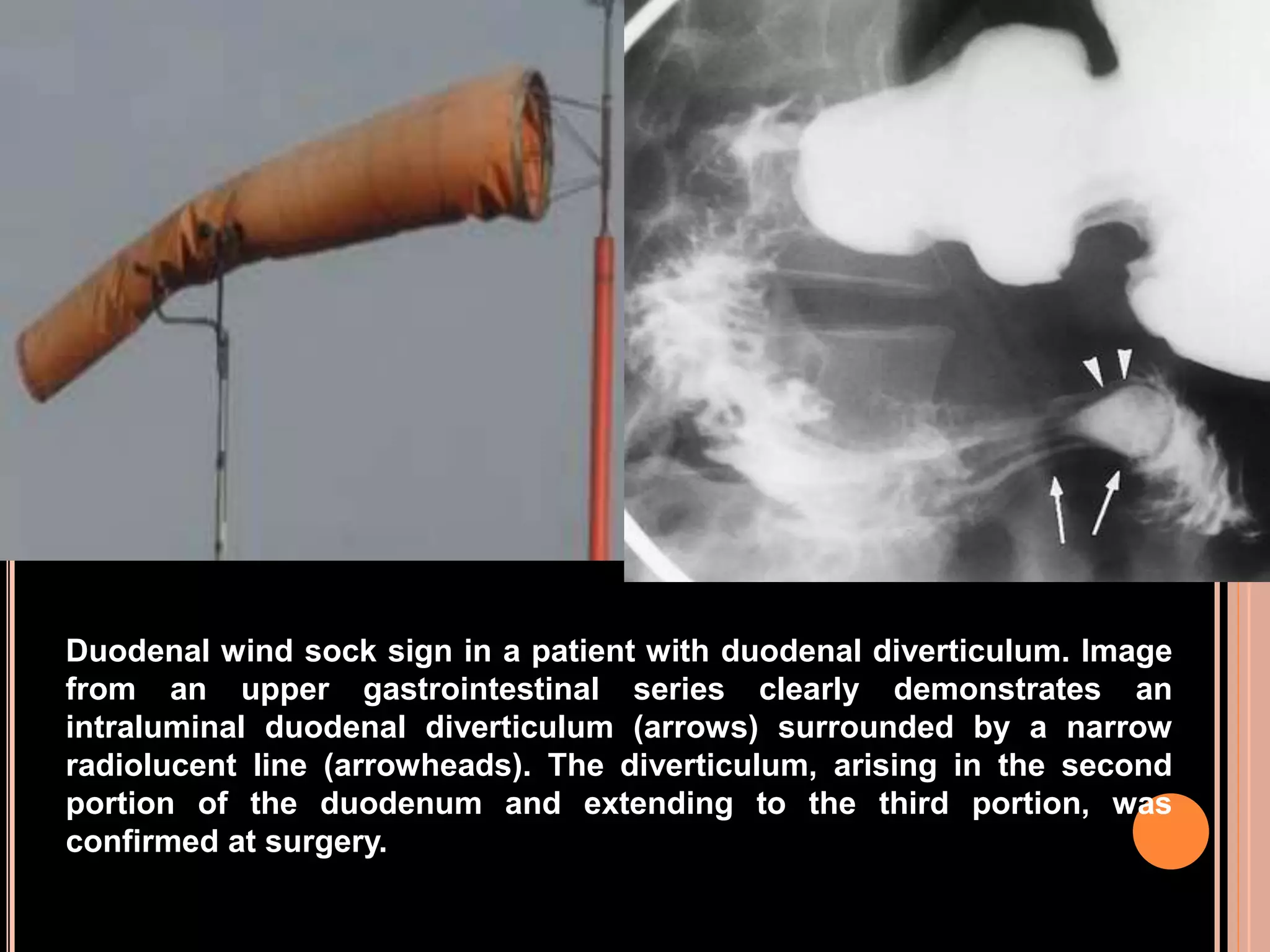Radiology ----Classical Signs in GIT Dr. Muhammad Bin Zulfiqar | PPTX