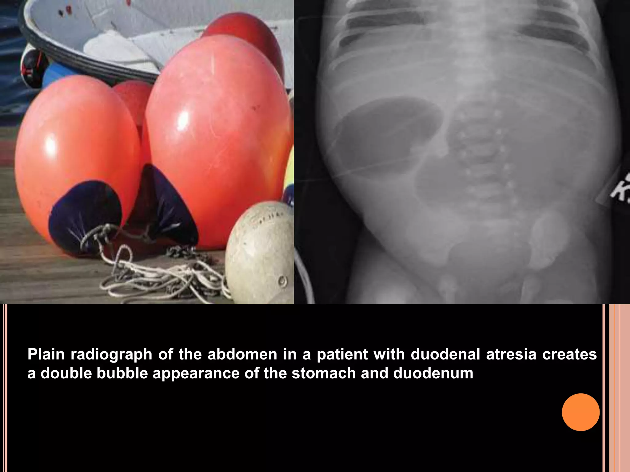 Radiology ----Classical Signs in GIT Dr. Muhammad Bin Zulfiqar | PPTX