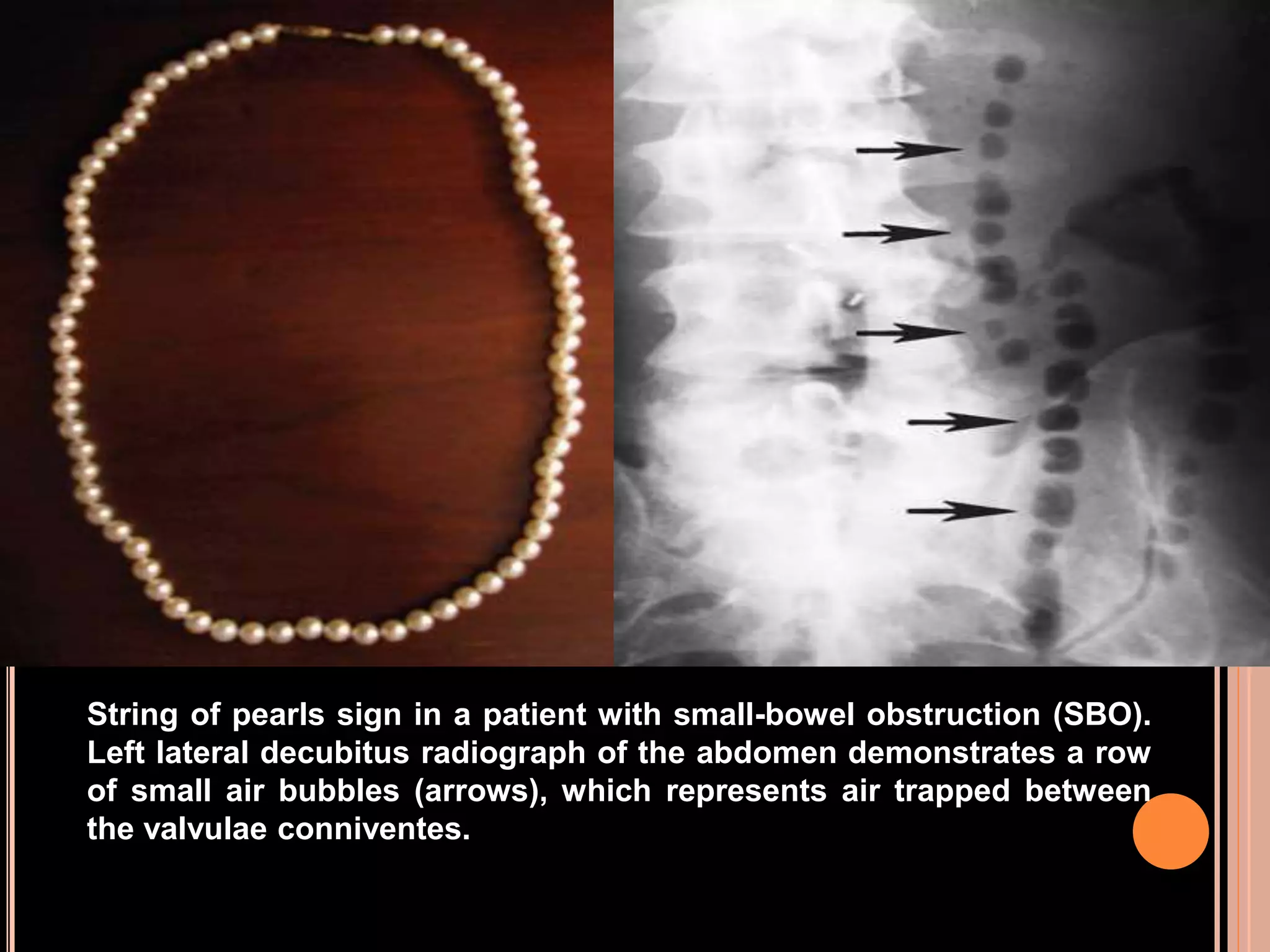 Radiology ----Classical Signs in GIT Dr. Muhammad Bin Zulfiqar | PPTX