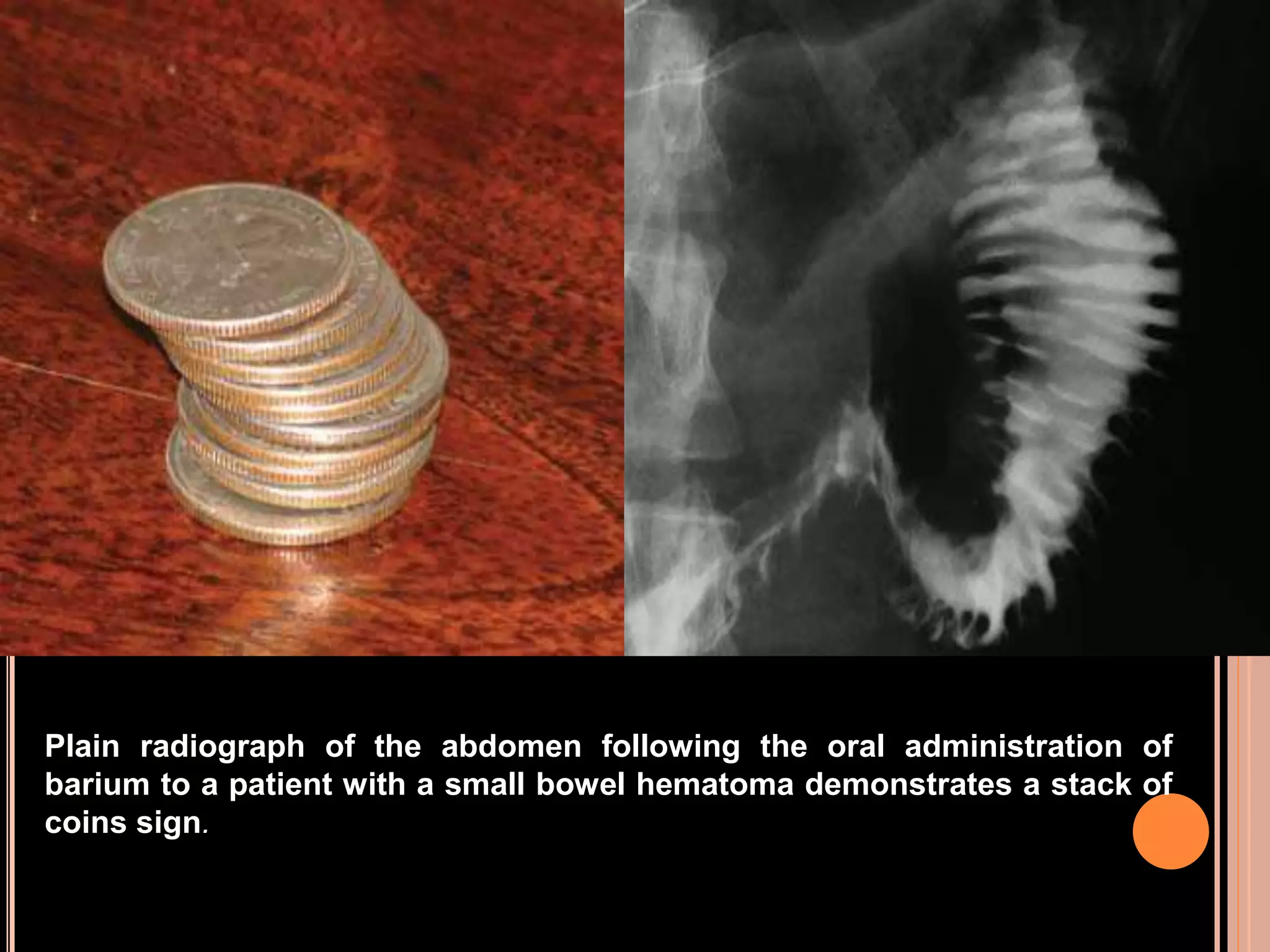 Radiology ----Classical Signs in GIT Dr. Muhammad Bin Zulfiqar | PPTX