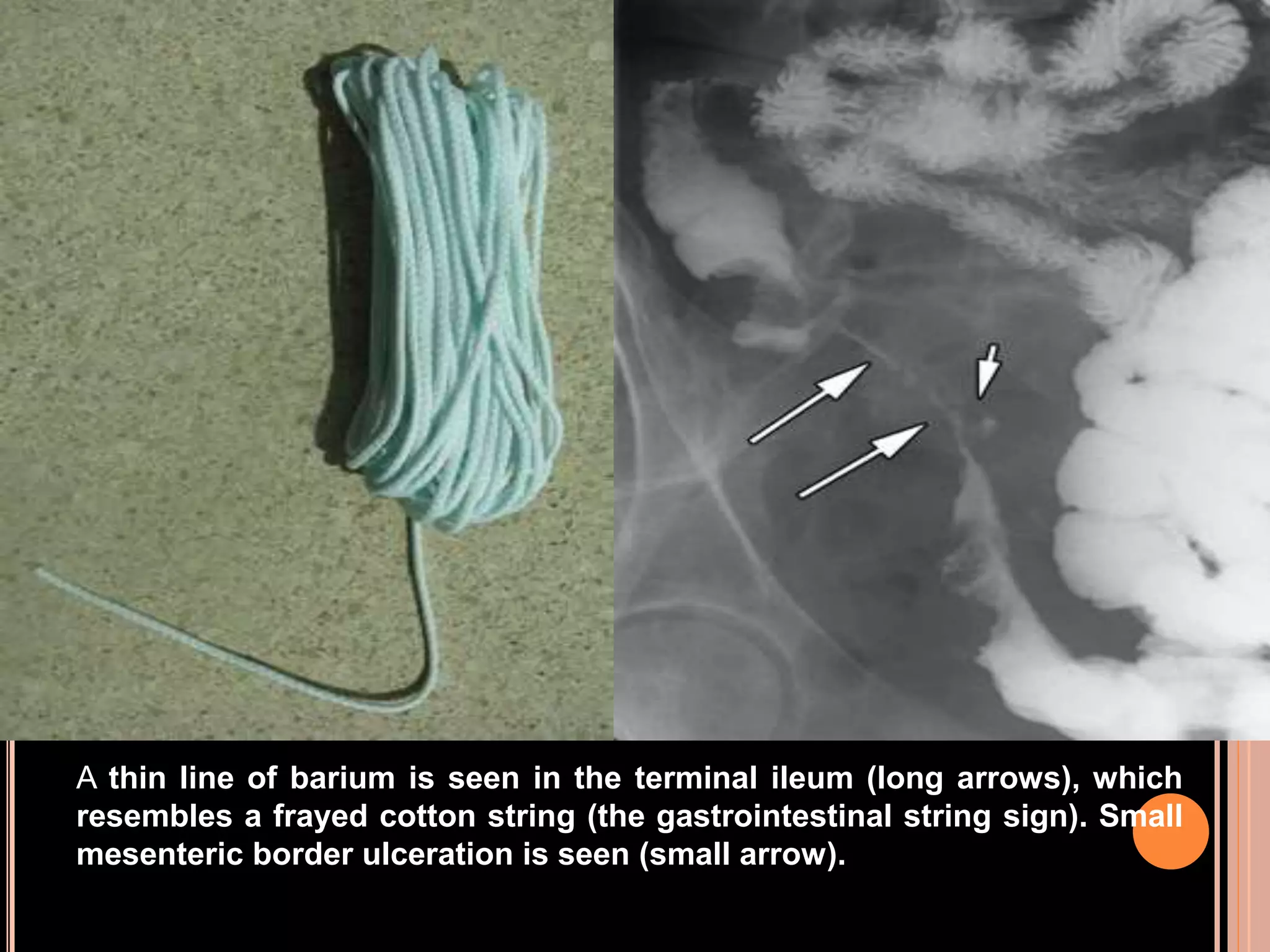 Radiology ----Classical Signs in GIT Dr. Muhammad Bin Zulfiqar | PPTX