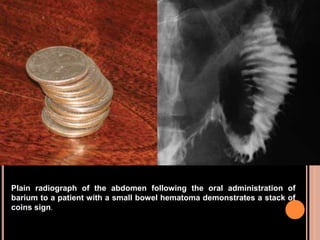 Radiology ----Classical Signs in GIT Dr. Muhammad Bin Zulfiqar | PPTX