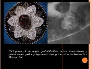 Radiology ----Classical Signs in GIT Dr. Muhammad Bin Zulfiqar | PPTX