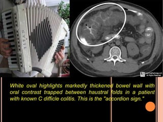 Radiology ----Classical Signs in GIT Dr. Muhammad Bin Zulfiqar | PPTX