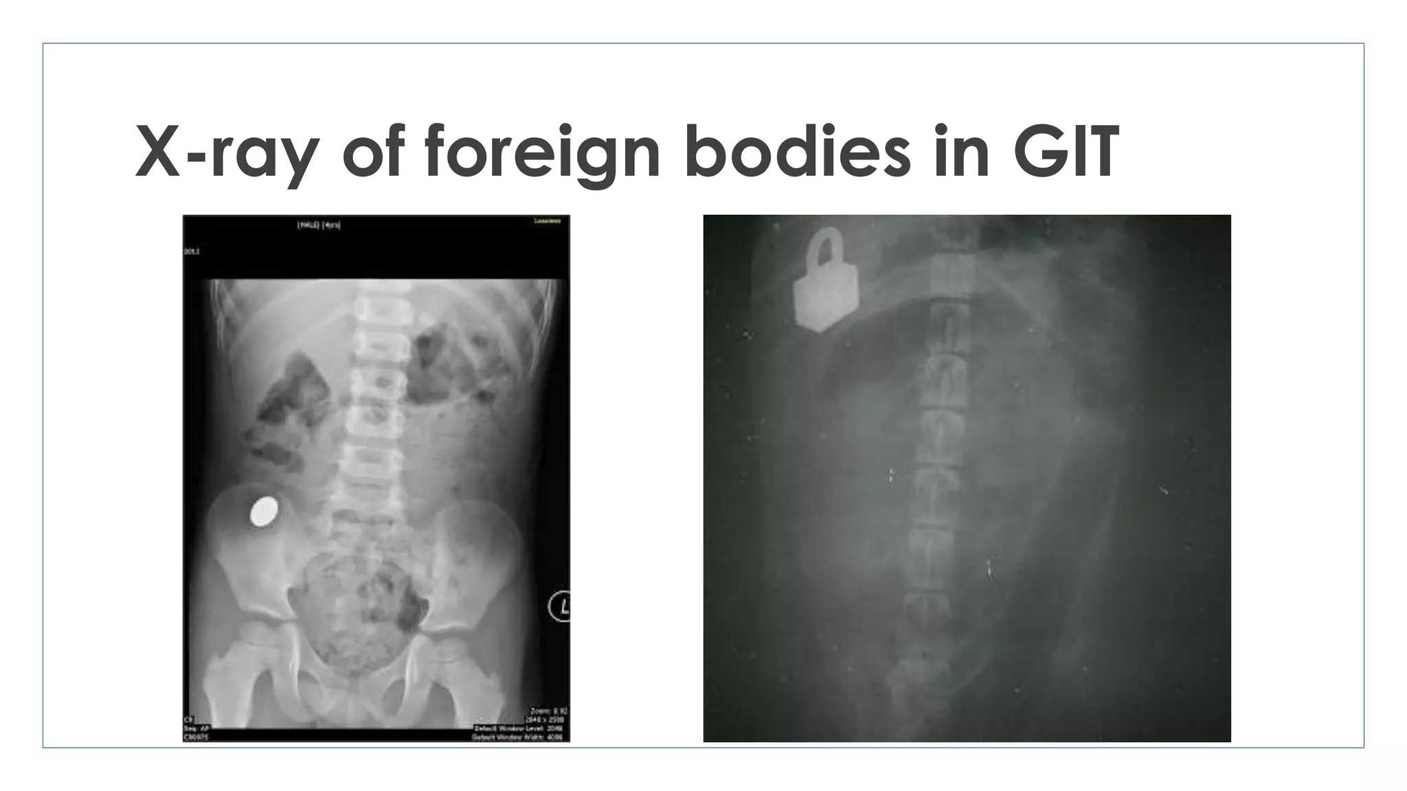Radiological diagnosis of foreign body | PPTX
