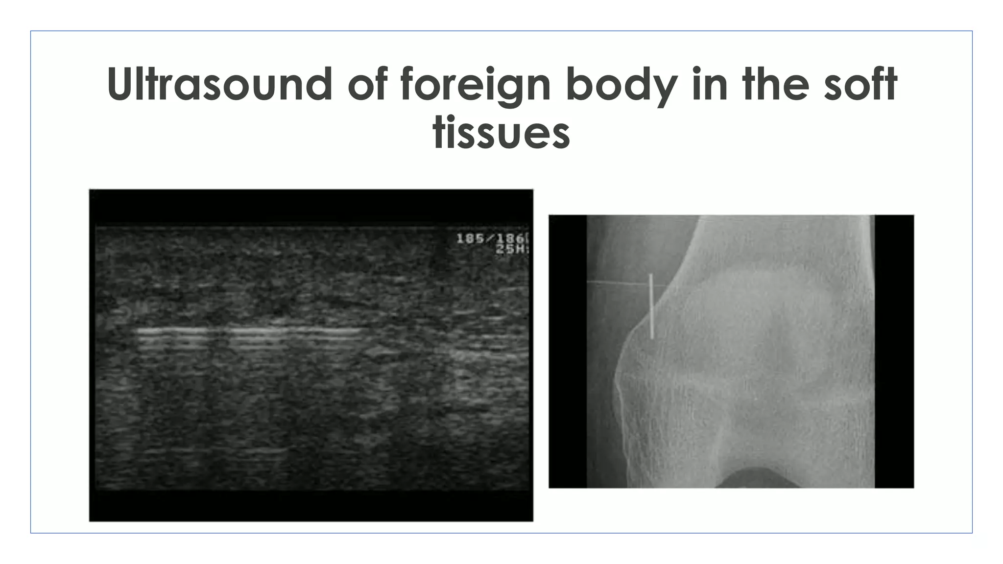 Radiological diagnosis of foreign body | PPTX