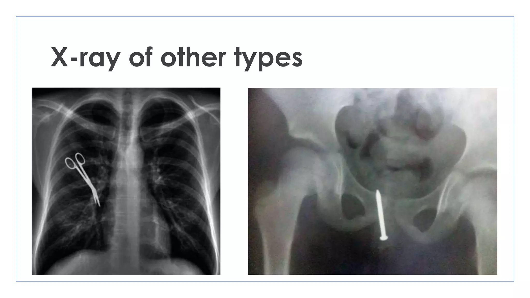 Radiological diagnosis of foreign body | PPTX