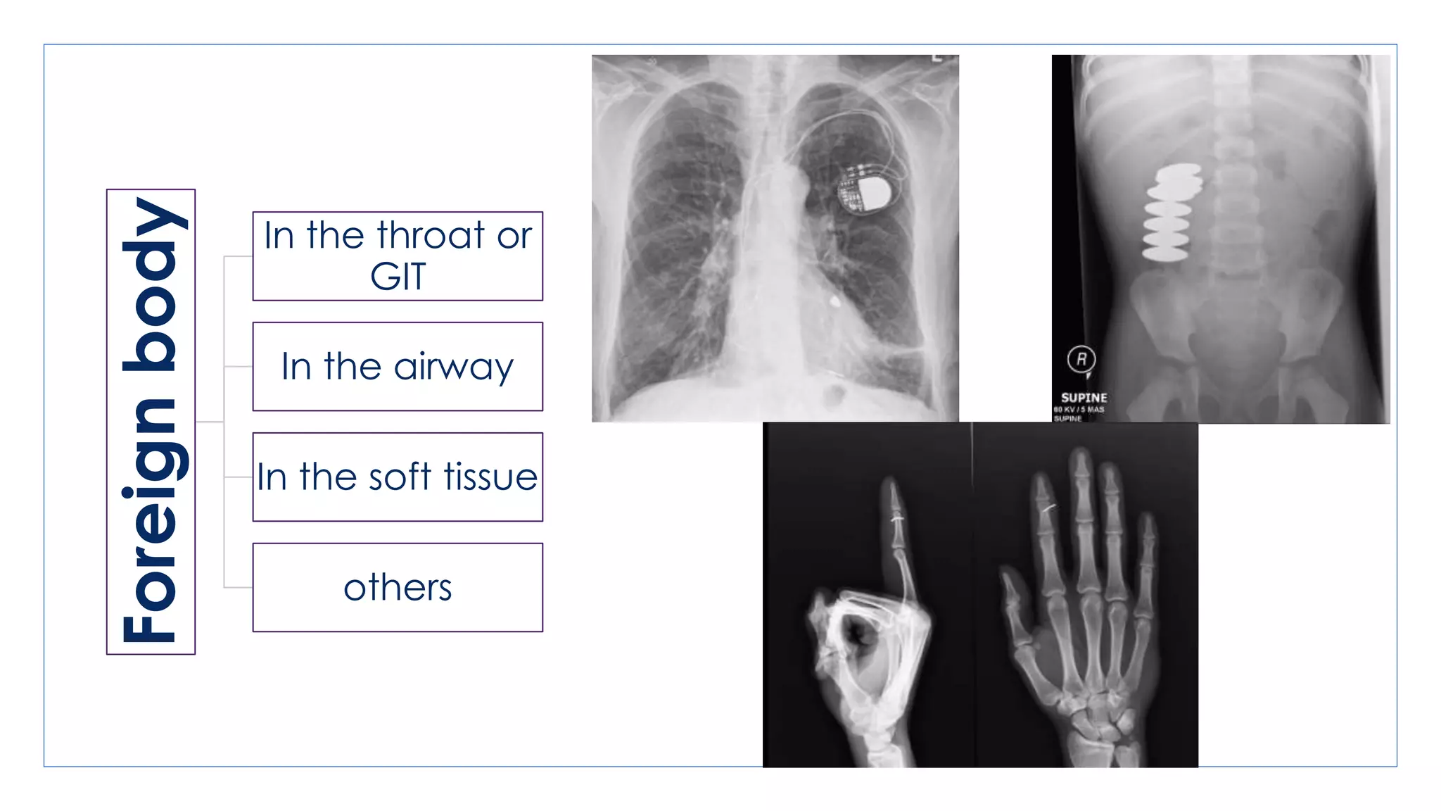 Radiological diagnosis of foreign body | PPTX