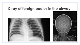 Radiological diagnosis of foreign body | PPTX