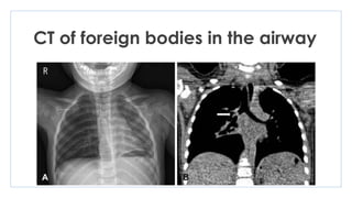 Radiological diagnosis of foreign body | PPTX