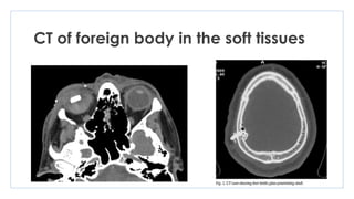 Radiological diagnosis of foreign body | PPTX