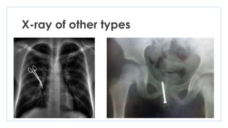 Radiological diagnosis of foreign body | PPTX