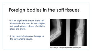 Radiological diagnosis of foreign body | PPTX