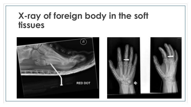 Radiological diagnosis of foreign body