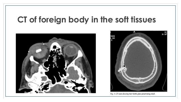 Radiological diagnosis of foreign body