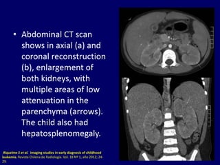 Radiological approach to leukemia | PPT