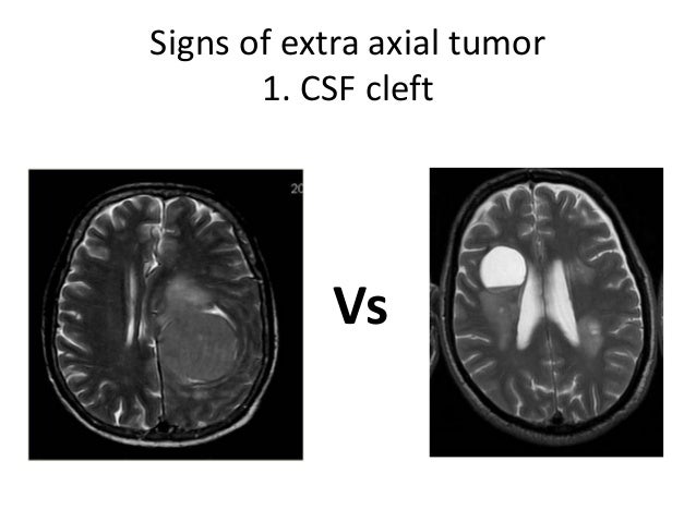 Radiological Evaluation of CNS Tumors