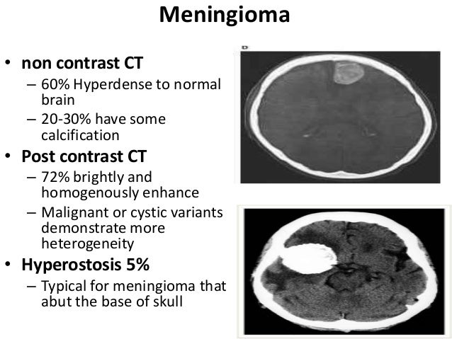 Radiological Evaluation of CNS Tumors