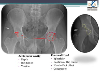 Radiological evaluation of hip pn | PPTX