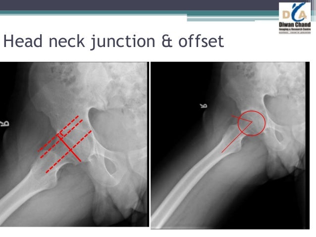 Radiological evaluation of hip pn