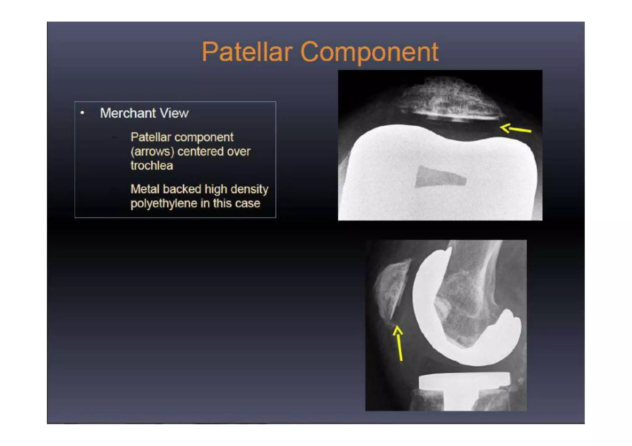Radiological evaluation of TKR by Dr. D. P. Swami | PPTX