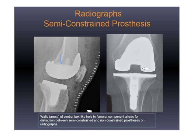 Radiological evaluation of TKR by Dr. D. P. Swami | PPTX