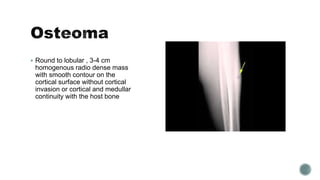 Radiological features in bone tumors | PPTX