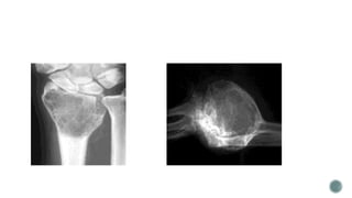 Radiological features in bone tumors | PPTX