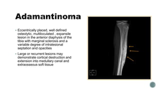 Radiological features in bone tumors | PPTX