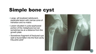 Radiological features in bone tumors | PPTX