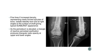 Radiological features in bone tumors | PPTX