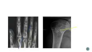 Radiological features in bone tumors | PPTX