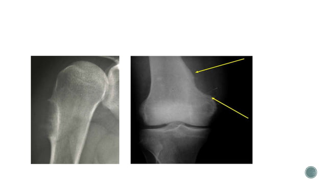 Radiological features in bone tumors | PPTX | Bone and Joint Conditions ...
