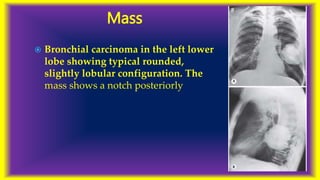 Radiological features of Lung cancer Dr. Muhammad Bin Zulfiqar | PPTX