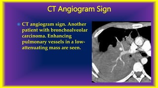Radiological features of Lung cancer Dr. Muhammad Bin Zulfiqar | PPTX